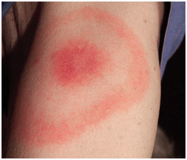 Essential Lyme Disease Guidelines Every Pediatrician Should Know